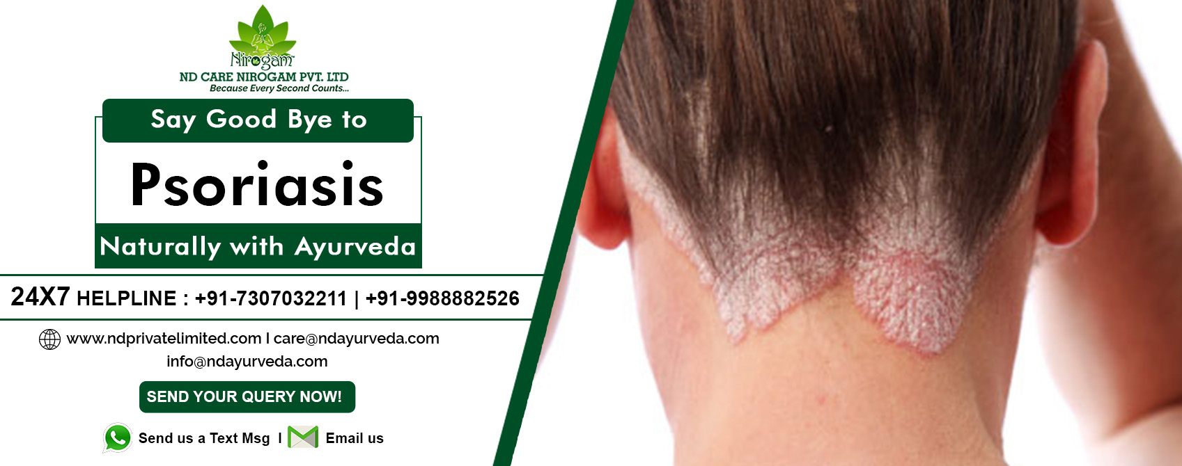 Ayurvedic Treatment of Psoriasis | ND Care Nirogam Pvt. Ltd.
